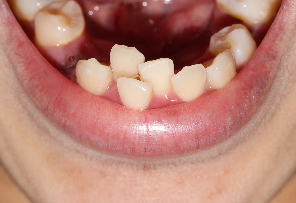 Teeth Overlapping Causes And Treatment Options To Deal With It Teeth Overlapping Causes And Treatment Options To Deal With It