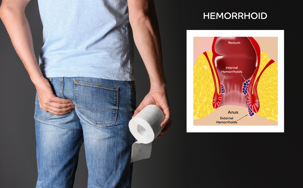 What Are The Fastest Ways For External Hemorrhoids Treatment At Home 