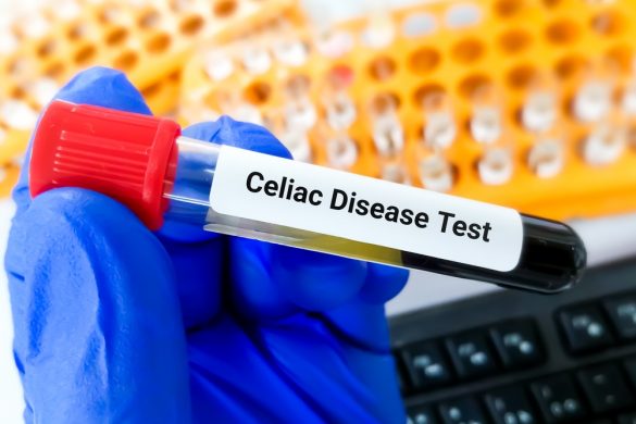 Cobblestone Throat - Home Remedies to Get Rid of Bumps in Throat ...