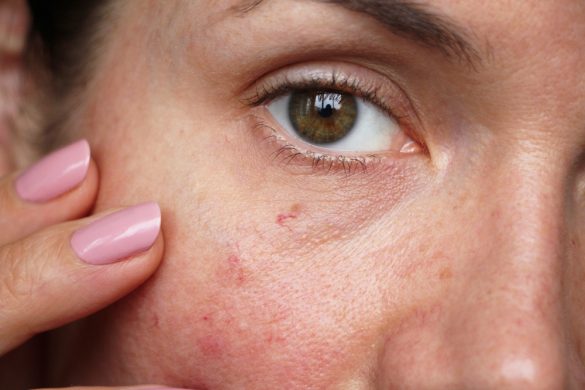 How to Keep Your Skin Safe from Toasted Skin Syndrome? - Healthwire