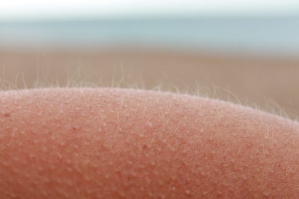 How to Keep Your Skin Safe from Toasted Skin Syndrome? - Healthwire