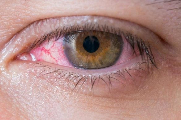 Crusty Eyes in the Morning - What to Do About that Sticky Mucus ...