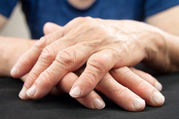 The Bitter Pain of Migraine (Sar Dard) - Types, Symptoms, and Treatments