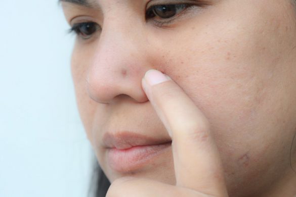Why Do You Get Scabs in Nose & What to Do About It? - Healthwire